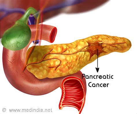 New Hope For Early Pancreatic Cancer Detection