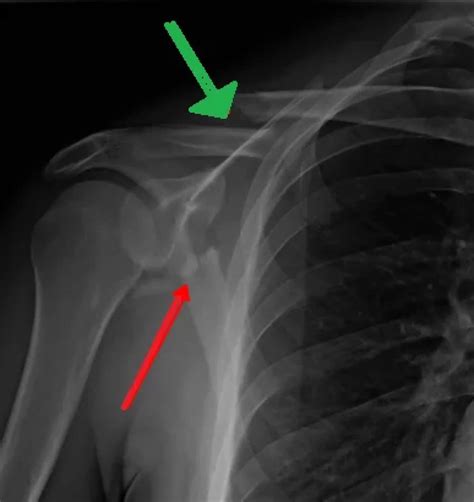 Scapula Fracture Broken Shoulder Blade Bone