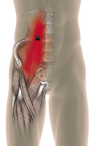 Trigger Point Therapy Treating The Iliopsoas Group Artofit