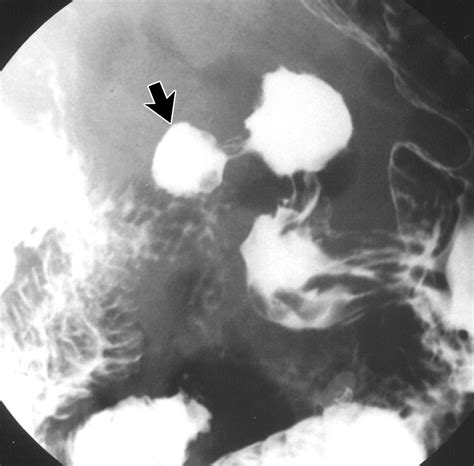 Upper Gastrointestinal Tract Barium Examination Of Postbulbar Duodenal Ulcers Ajr