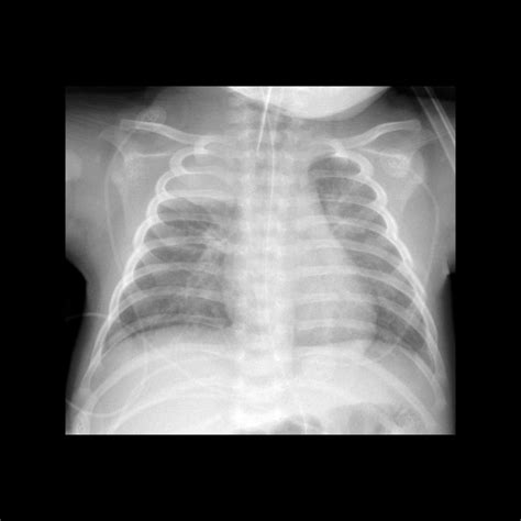 Pediatric Rib Fracture Pediatric Radiology Reference Article Pediatric Imaging Pedsimaging