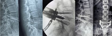High Grade Listhesis Pre Operative Intraoperative And Post Operative Download Scientific