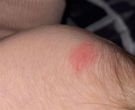 12mo Has Red Patch On Forehead R Dermatologyquestions