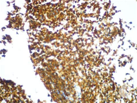 Bone Marrow Necrosis 3