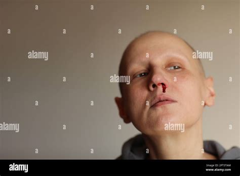 Young Bald Cancer Sick Woman Is Bleeding From Her Nose Effects Of Chemotherapy Female Lost Her