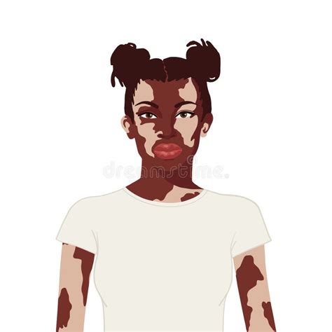 Vitiligo Cartoon Drawing