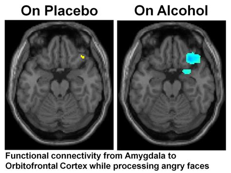 Alcohol And Depression Brain Scan