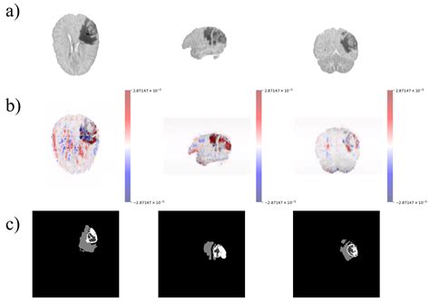 interpretable machine learning with brain image and survival data