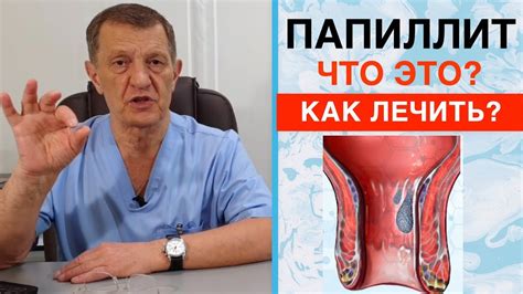 ПАПИЛЛИТ – что это и как лечить? - YouTube