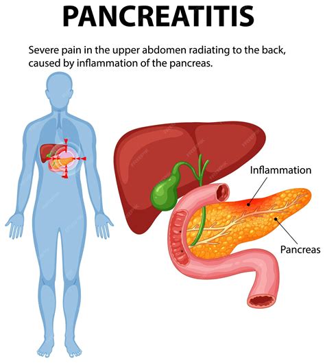 Comprender La Pancreatitis Y Sus Síntomas Vector Gratis