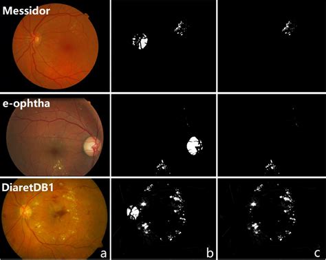 Figure 1 From Automated Retinal Lesion Detection Via Image Saliency Analysis Semantic Scholar