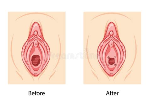 Hymenoplasty Before And After Hymen Repair Restoration Revirginization
