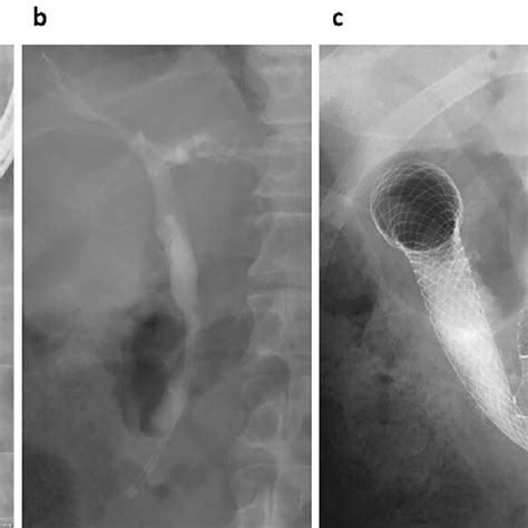 Figure3 Endoscopic Retrograde Cholangiography Demonstrating A Short