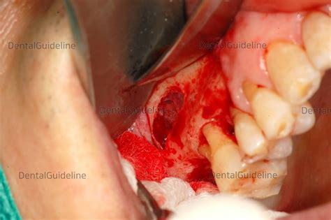 Mx Sinus Graft And Year Follow Up Dental Forums Dentalguideline