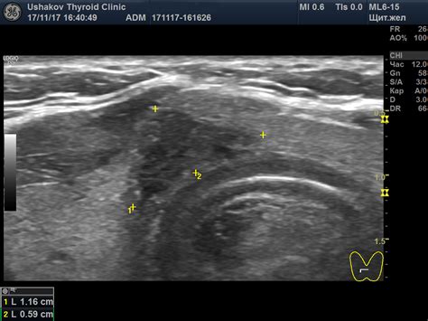 Критерий рака узлов при УЗИ щитовидной расположение узла продольно или поперечно доли Новости