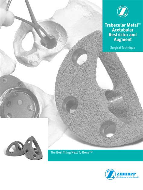 Trabecular Metal Acetabular Restrictor Augment Surgical Technique Pdf Implant Medicine Screw