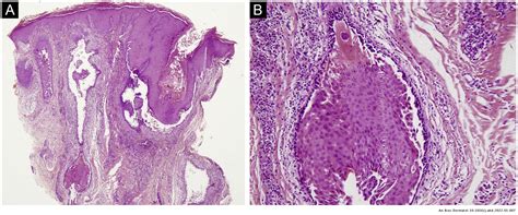 Recalcitrant Vegetative And Nodular Scalp Lesions On The Vertex In Pemphigus Patients An