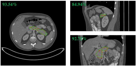 Globally Guided Progressive Fusion Network For 3d Pancreas Segmentation Chaowei Fang