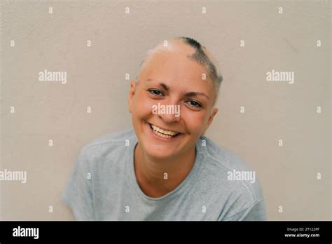 Real Alopecia Areata In A Young Girl A Bald Head In A Person Diffuse