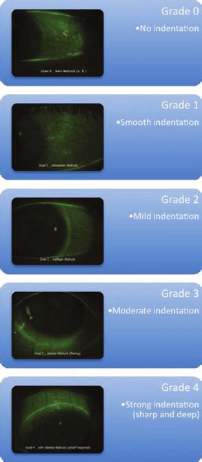 Conjunctival Indentation Grading Scale Hubner Et Al 2009 Download