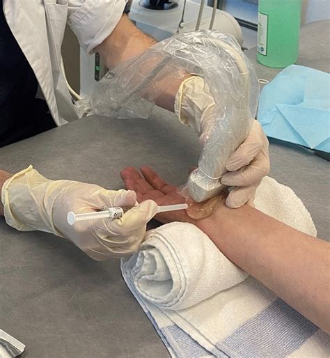 Nerve Hydrodissection For Nerve Pain In Nagpur