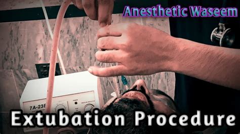What Is The Process Of Extubation At Phillip Dorsey Blog