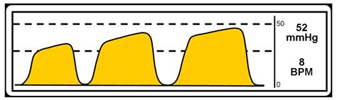 Normal End Tidal Co2 Waveform Flexbubble