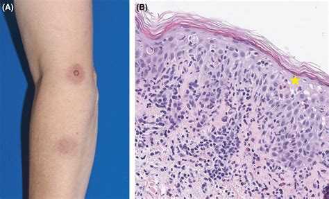 A Indurated Dusky Erythematous Plaques In Areas Of Prior Involvement Download Scientific