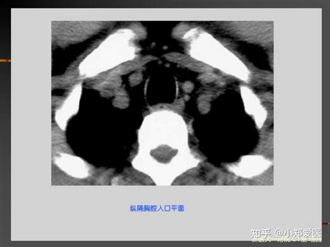 从0到1带你学会读ct片之呼吸系统影像学诊断（科普） 知乎