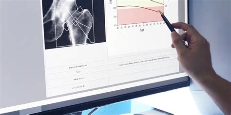 Frax Score Measuring Your Osteoporosis Fracture Risk