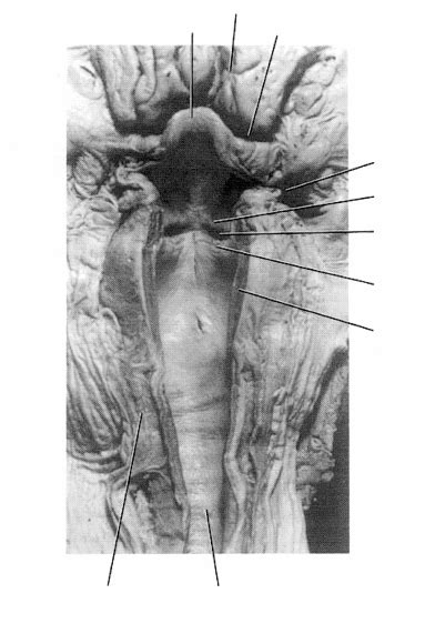 Ventricular Folds Cadaver