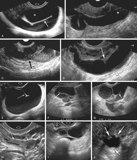 Ultrasound Evaluation Of The Fallopian Tube Clinical Tree