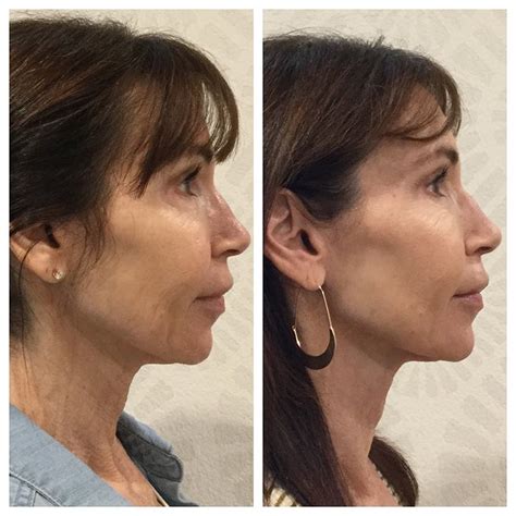 Patient 27019016 Ultherapy Before And After Photos Saving Face Austin