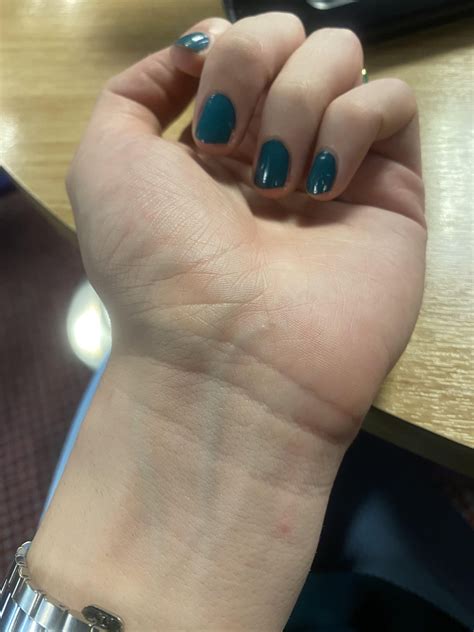 Have I Been Re Infected Done 20 Treatments Over The Last 2 Years R