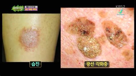 비타민 햇빛의 자외선 광노화 햇빛 알레르기 일광화상 광선 각화증 피부암 네이버 블로그