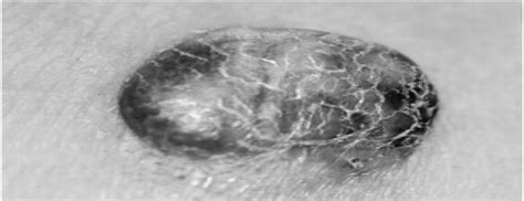 Giant Dermatofibroma With Monster Cells The American Journal Of