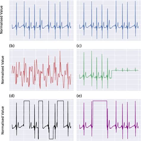 Example Of How An Original Ecg Sample A Is Modified By Addition Of Download Scientific