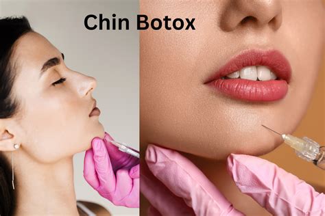 Chin Botox Before And After A Guide To Botox For Double Chin