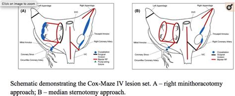 Schematic Demonstrating The Cox‐maze Iv Lesion Set A Right Download Scientific Diagram