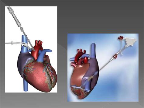 Clase 5 Ccv Unaj Reemplazo Valvula Aortica Y Mitral Ppt