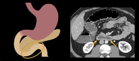 Abdominal Ct Small Intestine • Litfl • Radiology Library