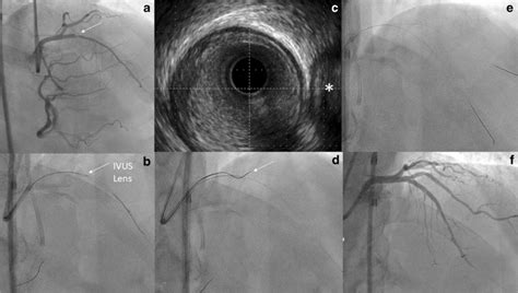 Ivus Guided Cto Revascularization A Cto Of The First Diagonal With Download Scientific Diagram