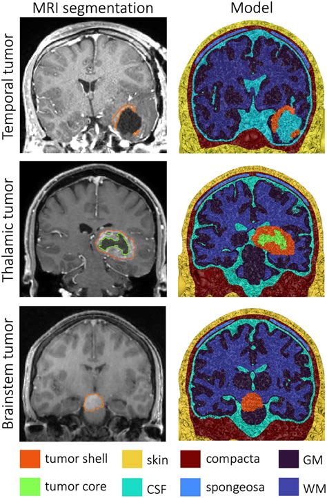 Tumor Head Models For Three Tumor Cases Tumors Were Segmented From Download Scientific