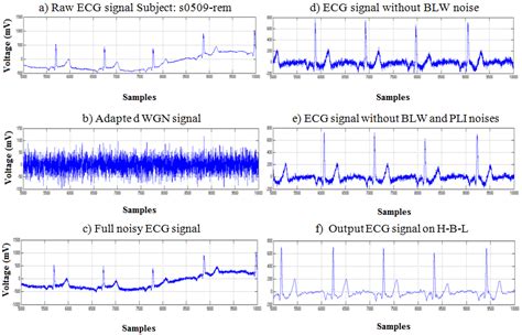 Steps Of De Noising Ecg Signal Using The H B L Configuration Download