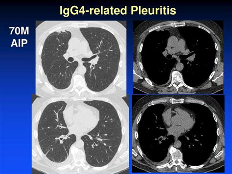 Ppt Igg4 Related Disease And Lung Involvement Powerpoint Presentation Id 5687692