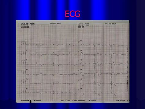 Simple Errorsin Ecg Pptx