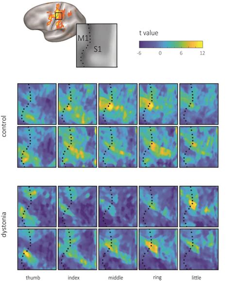 individual activity patterns of finger representations in the left