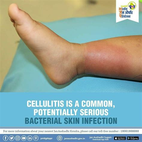 Insect Bite Cellulitis Treatment At Laverne Kelleher Blog