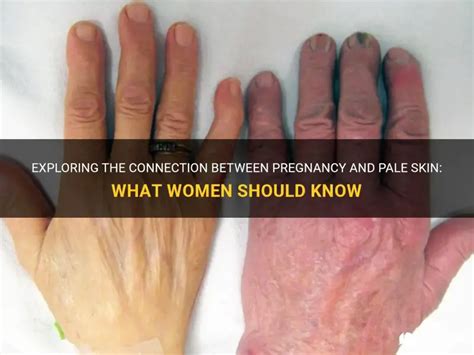 Exploring The Connection Between Pregnancy And Pale Skin What Women