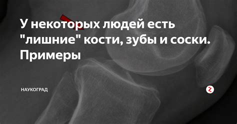 У некоторых людей есть лишние кости зубы и соски Примеры